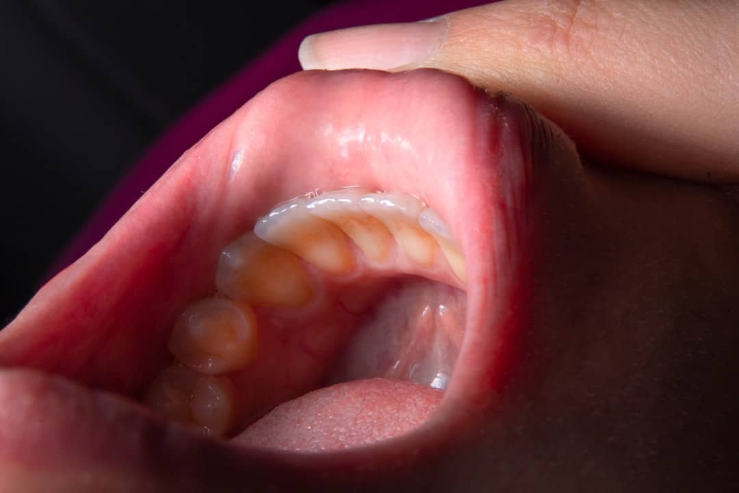 Bleeding Gums When Brushing: Causes and Solutions - The Face Dental Group